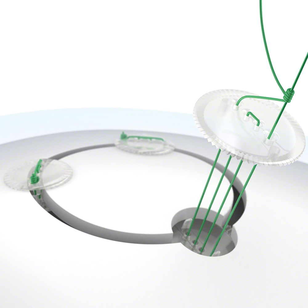 CranioFix® absorbable